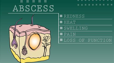Abscess Drainage Ocean Surgical