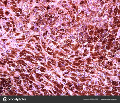 Human Lymph Node Metastasis Malignant Melanoma Normal Lymphoid Tissue