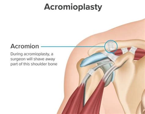 Acromioplasty Of The Shoulder Usa Spine Care And Orthopedics