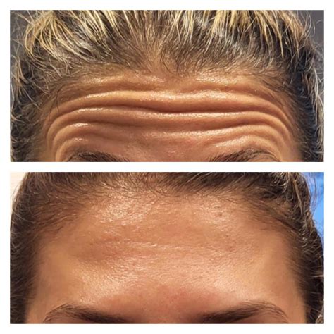 Botox In Paramus Nj Rejuvenate Look At Aesthetica Medspa