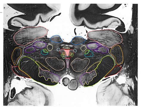 6 1 The Level Of The Pretectum Area Diagram Quizlet