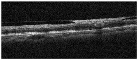 En Face Optical Coherence Tomography Angiography Of Neovascularization Imcrj