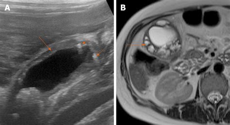 Adenomyomatosis Ultrasound
