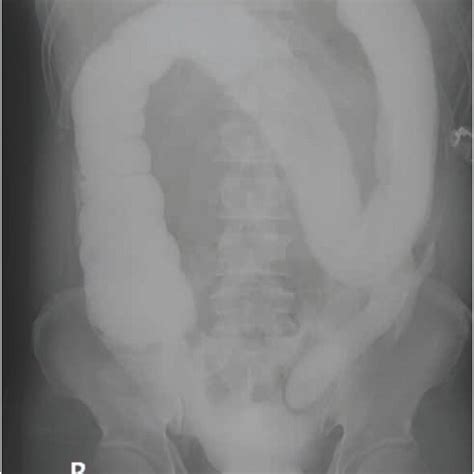Case 2 Ct Abdomen Done Eight Hours After The Distal Loopogram Showed Download Scientific