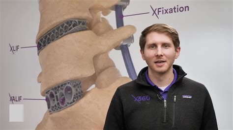 Nuvasive On Linkedin The Modulus Alif Interbody System Is The Latest