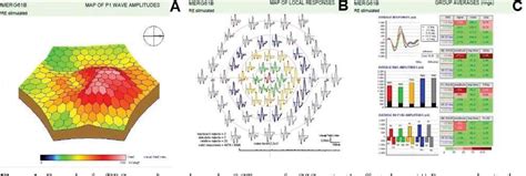 Figure 1 From Correlation Between Optical Coherence Tomography And Multifocal Electroretinogram