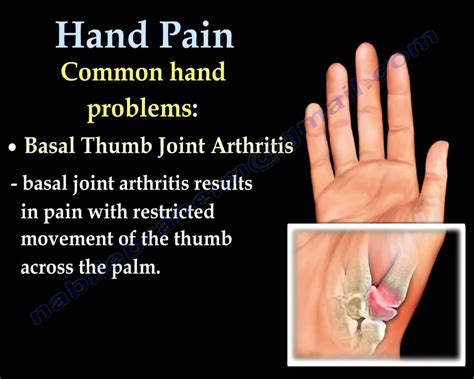Hand Pain Fingers Pain Everything You Need To Know Dr Nabil Ebraheim