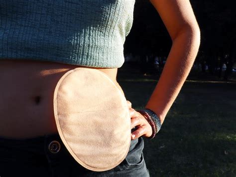 Urostomy Types Surgery Aftercare And Daily Living