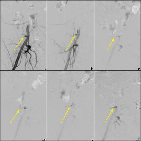 Arteriogram Of The Right External Iliac With Selective Catheterization