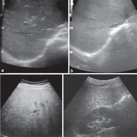 Pdf Imaging Of Non Alcoholic Fatty Liver Disease A Road Less Travelled
