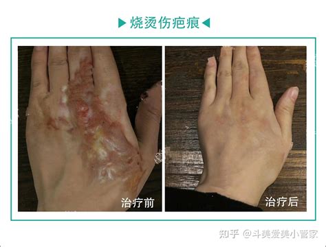 激光祛疤有效果吗有没有医生激光祛疤案例分享 知乎