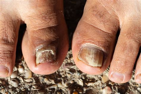 La Candidose ⋆ Vitalité Et Bien être