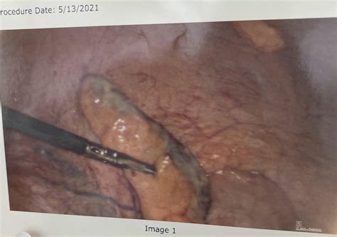 A Month Ago I Had My Appendix Removed And My Doctor Was Kind Enough To Take A Photo For Me R