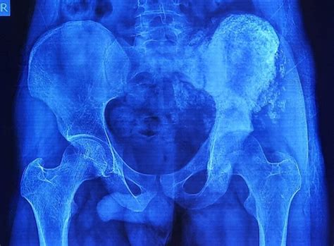 Mismanaged Pelvic Osteosarcoma Way To Heal