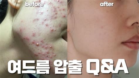 여드름 압출 Qanda 이 영상 하나로 종결 ㅣ여드름 압출 붉은기 ㅣ 압출 후 레이저 관리 필수 Youtube