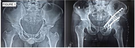 Figures Figure 1 T Type Acetabular Fracture Treated By Dual Plating Download Scientific