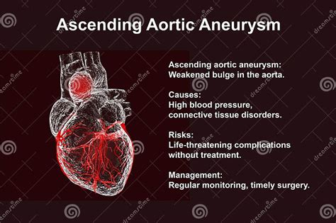 A Human Heart With An Ascending Aortic Aneurysm 3d Illustration Stock