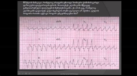 ეკგ ფართოკომპლექსიანი ტაქიკარდია ფილტვების შეშუპება ელექტრული კარდიოვერსია დიამორფინი
