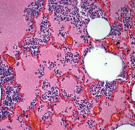 Pneumococcal Pneumonia Photograph By Steve Gschmeissnerscience Photo