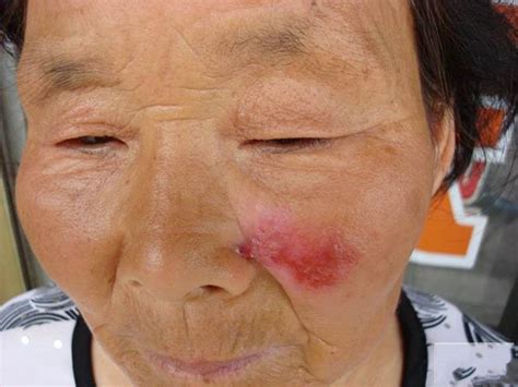 系统性红斑狼疮全身皮疹症状图 有来医生