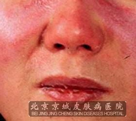 多发性皮肌炎的体征与并发症的关系有哪些 皮肌炎 北京京城皮肤医院 北京医保定点机构