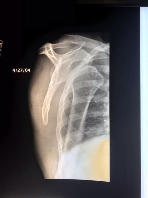 Scapula Y Xray 2 Diagram Quizlet