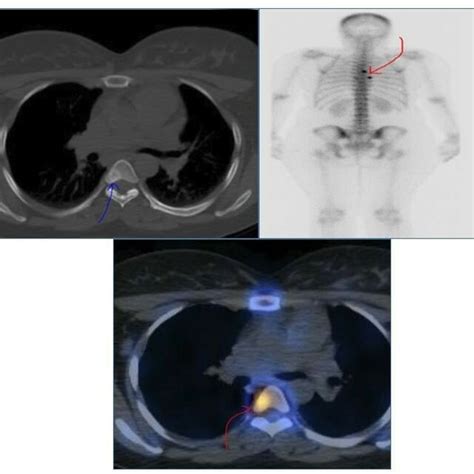 A Bone Scan Image Of Patient With Positive Bone Scan And Negative Ct Download Scientific Diagram