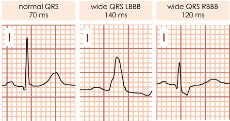 Wide Qrs Complex