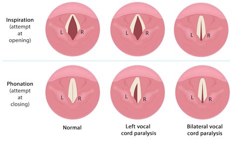Laryngeal Nerve Dysfunction Recurrent And Superior Laryngeal Nerves