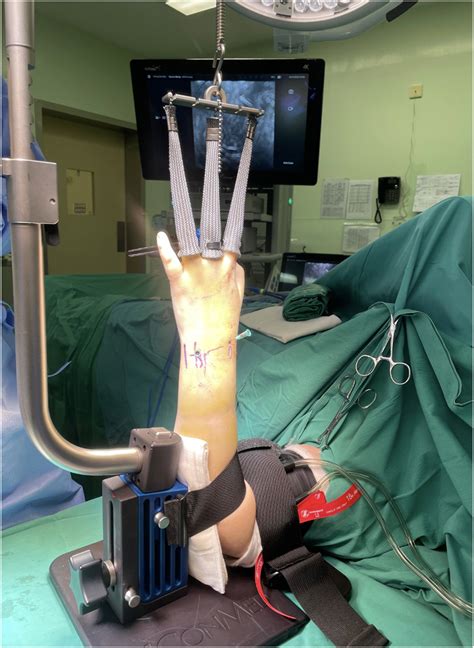Arthroscopic Assisted Distal Radius Fracture Fixation Using The