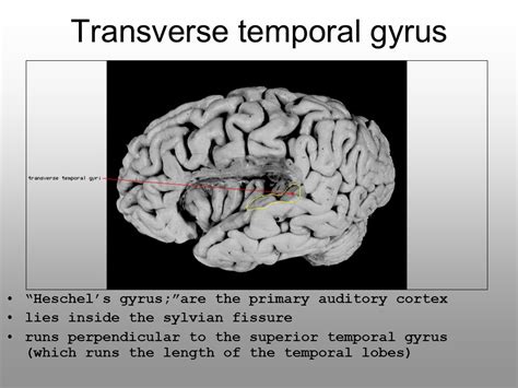 Transverse Temporal Gyrus