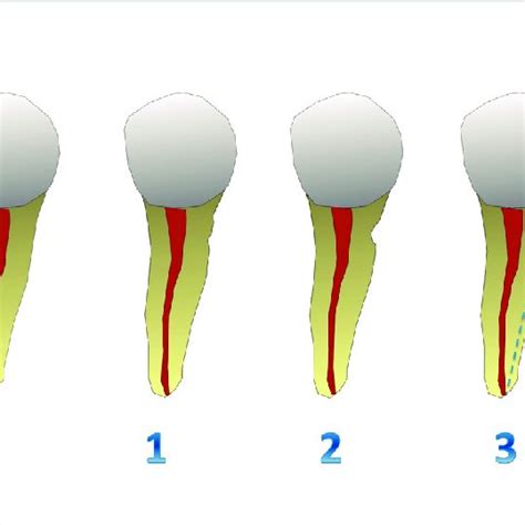 Classification Of Apical Root Resorption 0 Absence Of Resorption 1