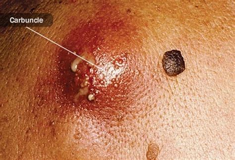 9 Early Signs Of Diabetes You May Not Be Noticing