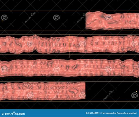 Ct Colonography Or Ct Scan Of Colon Rendering Image Stock Image Image Of Abdomen Digestive