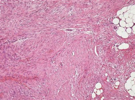 Histopathology Of The Mesenteric Mass Download Scientific Diagram