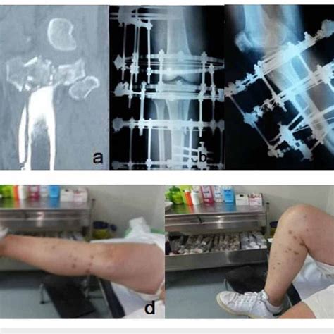 A 65 Year Old Man With A Schatzker Type Vi Tibial Plateau Fracture A Download Scientific