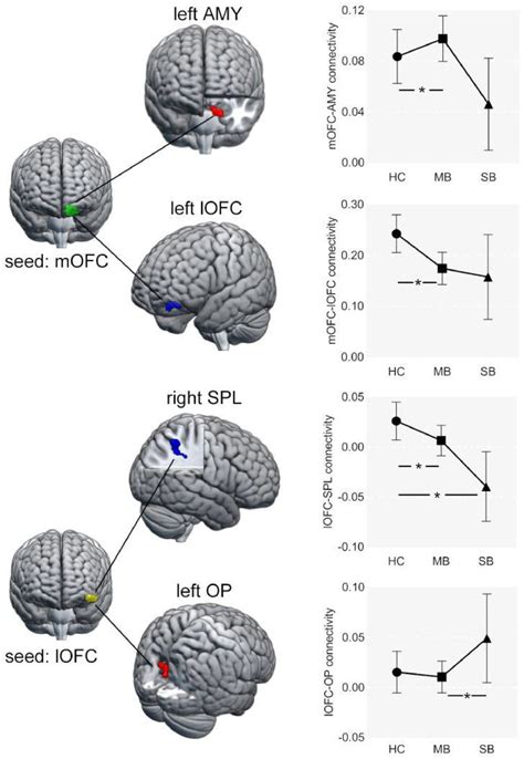 Altered Connectivity Patterns Of Medial And Lateral Orbitofrontal Cortex Underlie The Severity