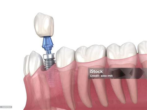 임플란트를 사용하면 전조 된 치아 회복 인간의 치아와 틀니 개념의 의학적으로 정확한 3d 그림 건강관리와 의술에 대한 스톡 사진