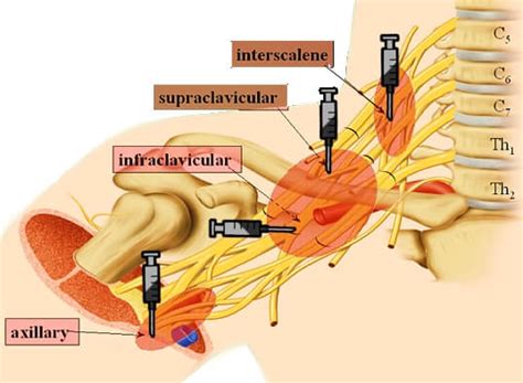Brachial Plexus Block Made Easy Epomedicine