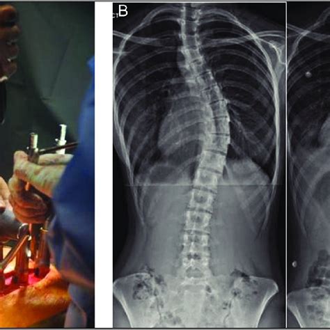 A Surgical Approach For Posterior Minimally Invasive Spinal Surgery