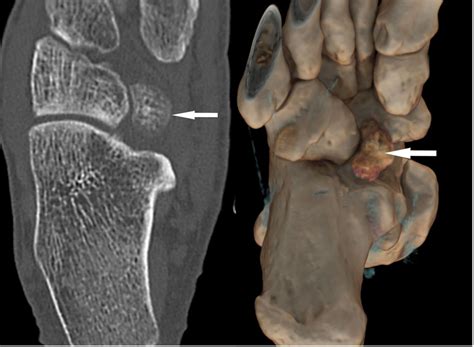 Os Cuboideum Secundarium A Rare Accessory Ossicle In The Foot