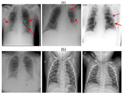Viral Pneumonia Chest X Ray