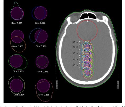 Figure 1 From The Predictive Value Of Segmentation Metrics On Dosimetry In Organs At Risk Of The