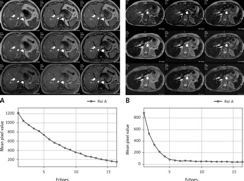 Liver Iron Quantification Mri Radiology At Deborah Mcgee Blog