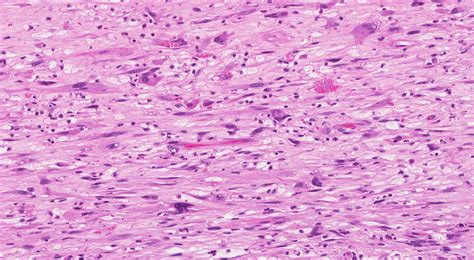 Ano Ang Isang Malignant Spindle Cell Neoplasm Mypathologyreport