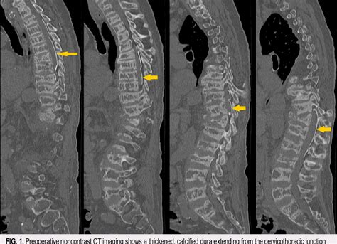Figure 1 From Compressive Myelopathy From Diffuse Spinal Dural Calcifications In A Patient With