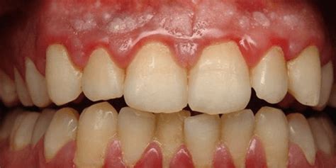 Gingivitis And Gum Disease Symptoms Causes And Treatment • Toothandgo