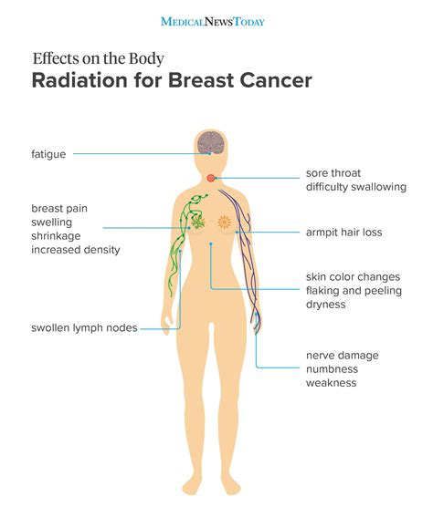 Radiation Therapy For Breast Cancer Long Term Side Effects All About
