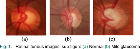 Figure 1 From Automated Classification Of Glaucoma Stages Using Flexible Analytic Wavelet