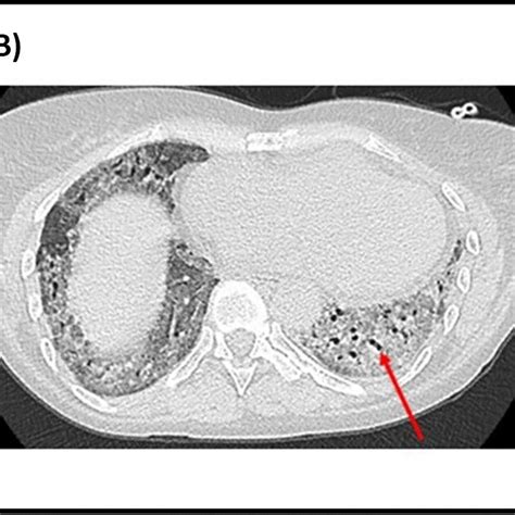Representative Axial Ct Scan Slices Of A Patient With Baseline Ssc Ild Download Scientific